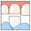 Strips Crowns in 5 Easy Steps - PULPDENT