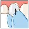 Strips Crowns in 5 Easy Steps - PULPDENT