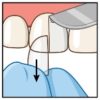 Strips Crowns in 5 Easy Steps - PULPDENT