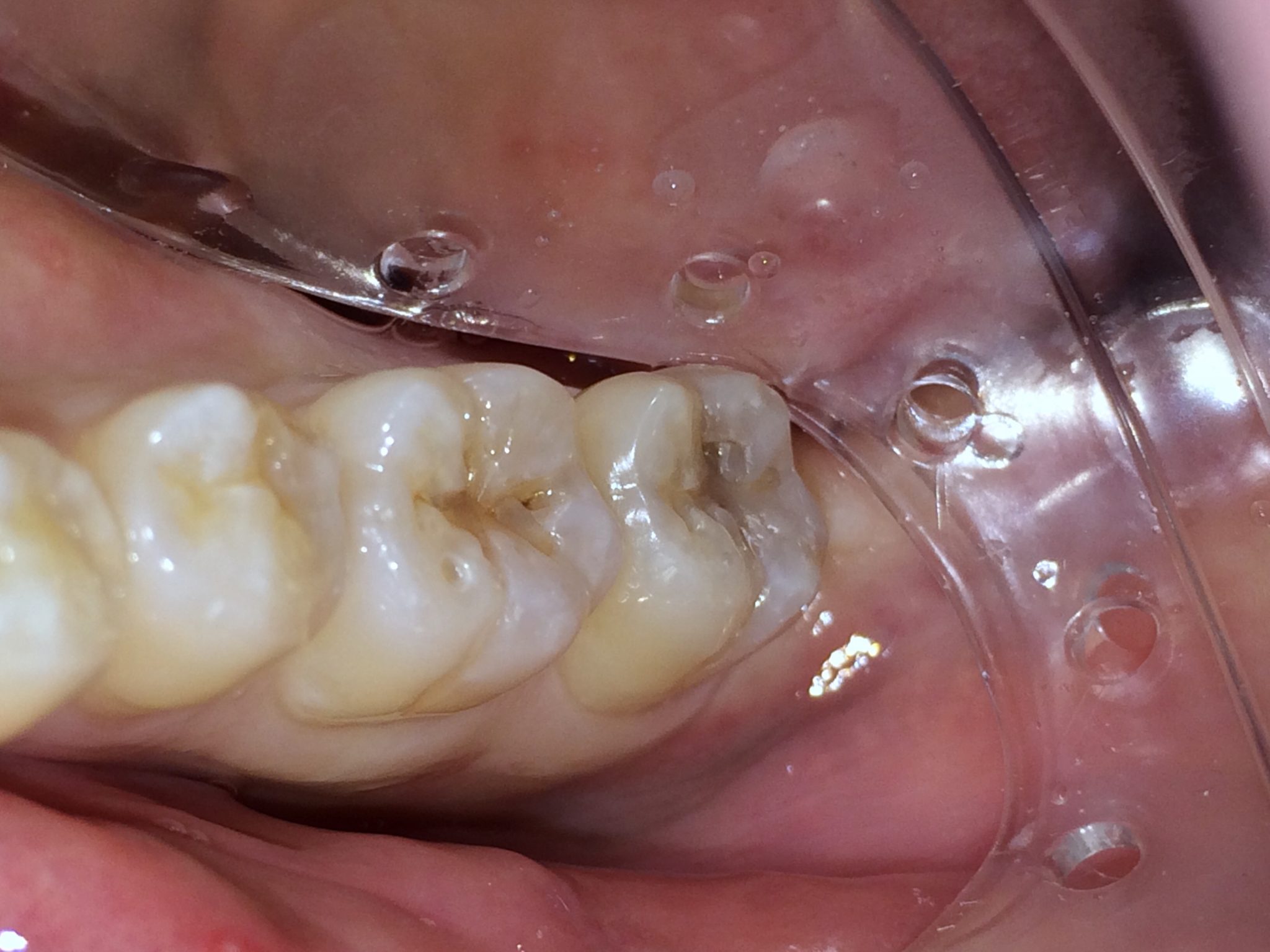 Heroic Dentistry: The Open Sandwich Technique - Pulpdent