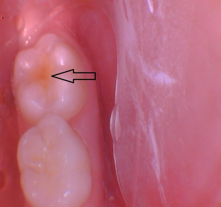 Direct from the Operatory: Embrace Pit & Fissure Sealant - PULPDENT