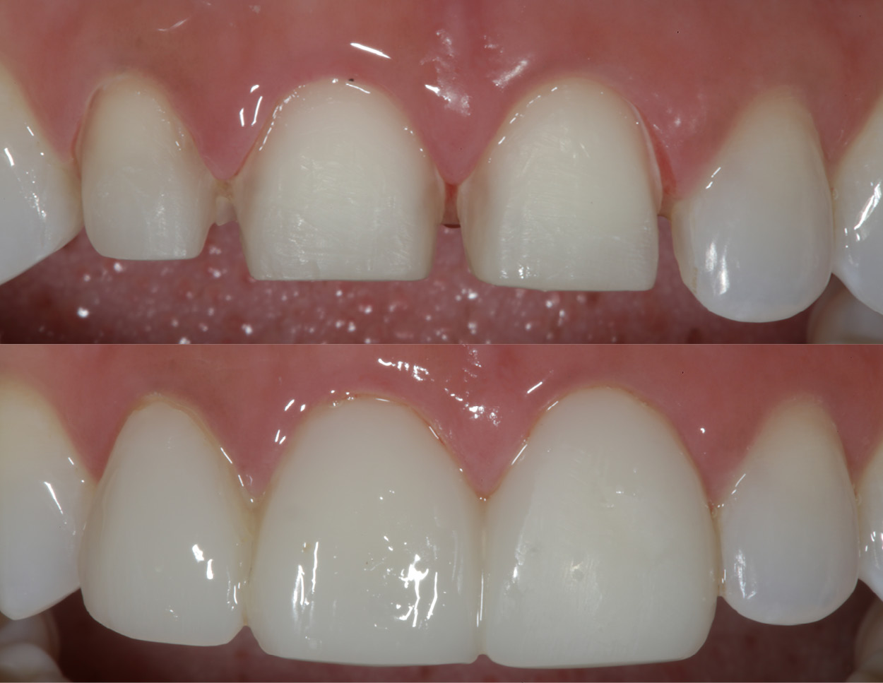 Direct from the Operatory: Tuff-Temp Plus - PULPDENT