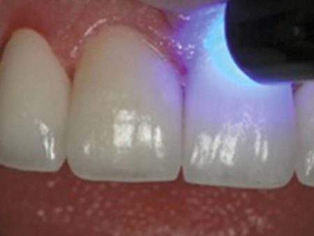 Kleer-Veneer™ - PULPDENT